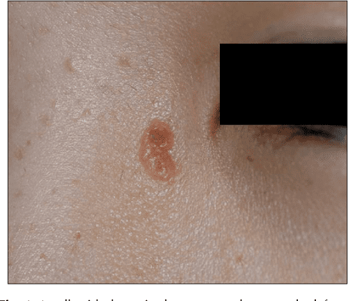 [PDF] Two Concurrent Facial Epidermal Nevi without Systemic ...