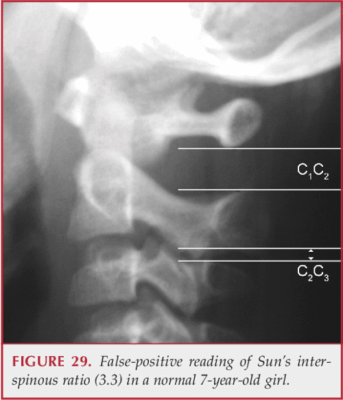 ATLANTO‐OCCIPITAL DISLOCATION—PART 2: THE CLINICAL USE OF (OCCIPITAL ...