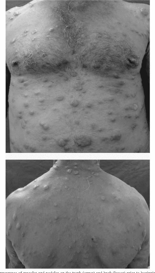 Figure 1 from Nodular secondary syphilis simulating lepromatous leprosy ...