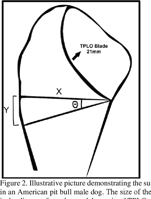 Figure 1 from Double plating technique for fixing tibial plateau ...