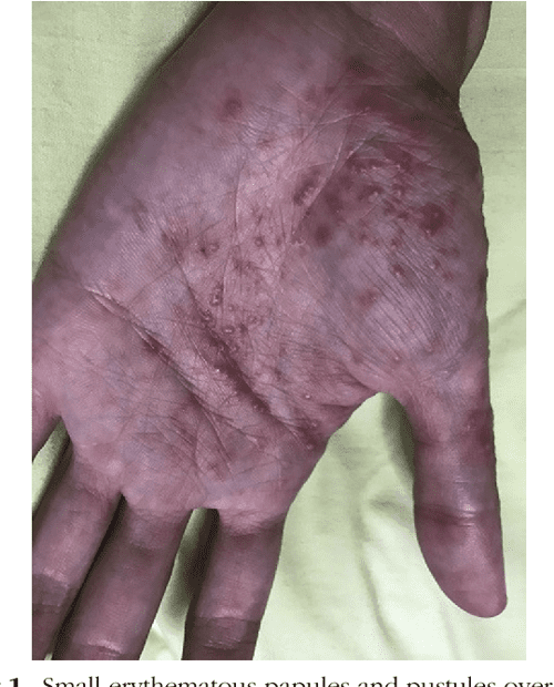 Figure 1 from Pustular tinea manuum from Trichophyton erinacei ...