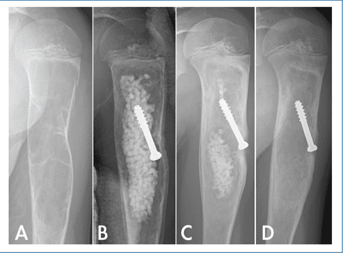 Figure 2 from Treatment of unicameral bone cyst: surgical technique ...