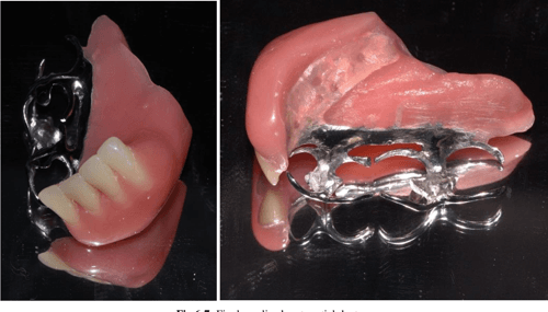 Figure 2 from Management of a hemimandibulectomy patient using a guide ...
