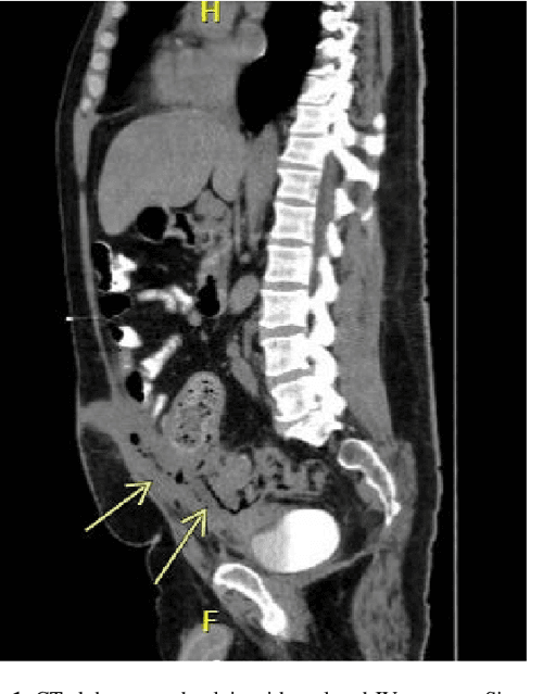 [PDF] Severe Ulcerative Colitis-like Pattern of Segmental Colitis ...