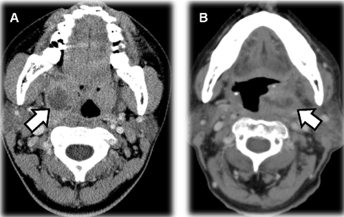 Figure 1 from Clinical classification of peritonsillar abscess based on ...