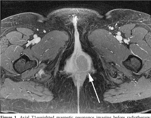 Figure 1 from Case report from Mayo Clinic: Locally advanced Bartholin ...