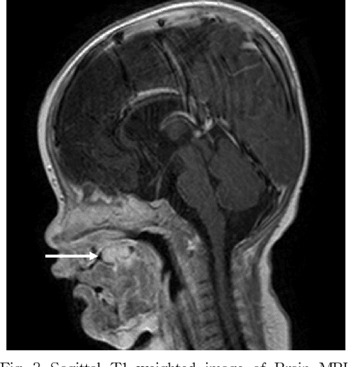 Figure 5 from A Case of Granulation Tissue of the Tongue in Infant ...
