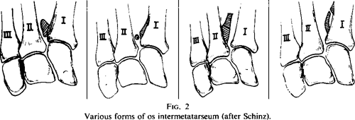 Figure 2 from Os intermetatarseum and a possible relationship to hallux ...