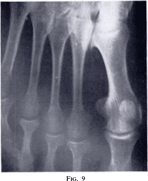 Figure 2 from Os intermetatarseum and a possible relationship to hallux ...