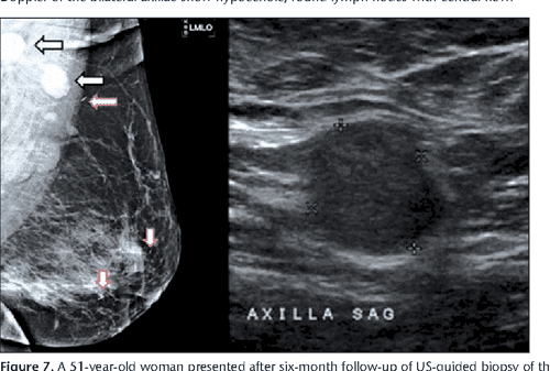 [PDF] Abnormal axillary lymph nodes on negative mammograms: causes ...