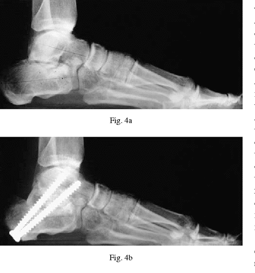 Figure 1 from Subtalar distraction bone block arthrodesis. | Semantic ...