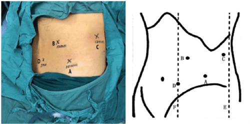 Figure 1 from Complete retroperitoneal laparoscopic nephroureterectomy ...