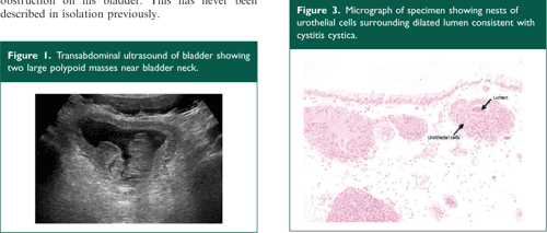 Cystitis cystica and glandularis producing large bladder masses in a 16 ...