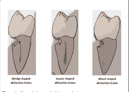 Noncarious Cervical Lesions as Abfraction: Etiology, Diagnosis, and ...
