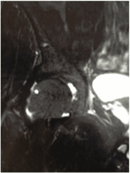 Figure 1 from Symptomatic synovial herniation pit—MRI appearances pre ...