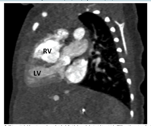PDF Cardiac CT Of A Criss Cross Heart A Case Report Semantic Scholar PDF Cardiac CT Of A Criss Cross Heart A Case Report Semantic Scholar