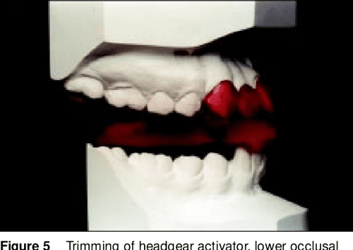 Figure 2 from Modified trimming of the van Beek headgear activator ...