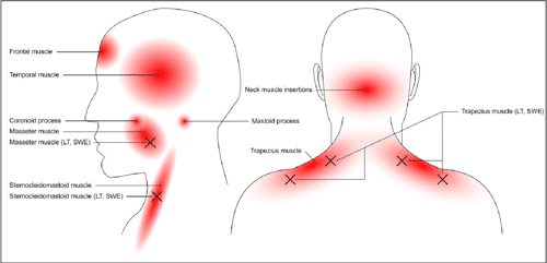Muscle stiffness in tension-type headache patients with pericranial ...