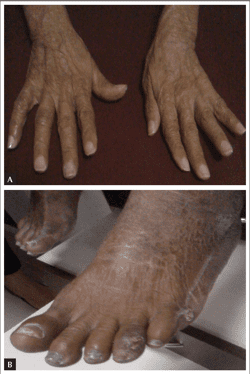 Figure 2 from Systemic manifestations and ulcerative skin lesions in ...