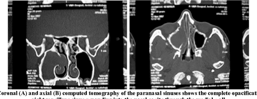 Figure 2 from Endoscopic middle meatal antrostomy in treatment of ...