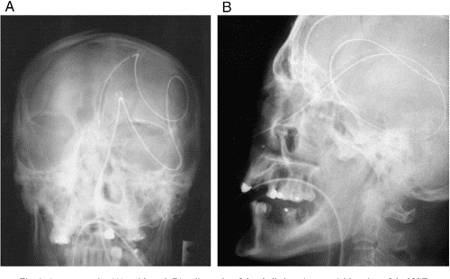Figure 2 from Inadvertent insertion of a nasogastric tube into the ...