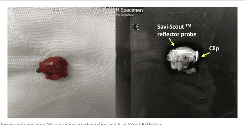 Figure 2 from A pioneer Australian case of Savi-Scout™ assisted ...
