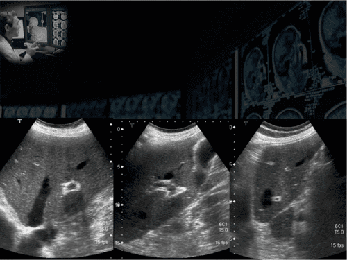 Ultrasound periportal cuffing: differential diagnosis | Semantic Scholar