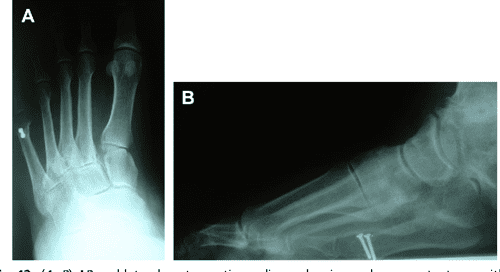 Figure 2 from Revisiting the tailor's bunion and adductovarus deformity ...