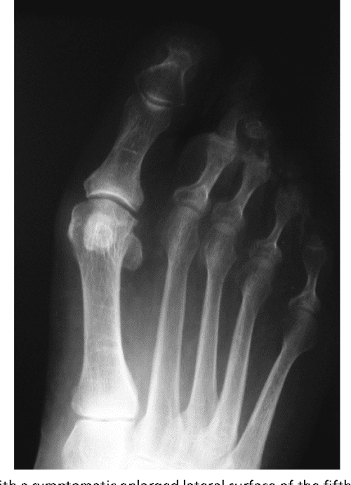 Figure 2 from Revisiting the tailor's bunion and adductovarus deformity ...