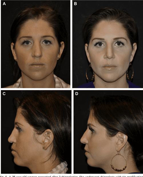 Pyriform Aperture Augmentation as An Adjunct to Rhinoplasty. | Semantic ...