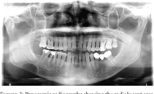 Figure 1 from Stafne Bone Defect: Report of Two Cases | Semantic Scholar