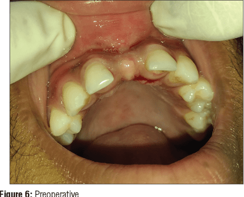 Figure 1 from Implant Placement into the Nasopalatine Foramen ...