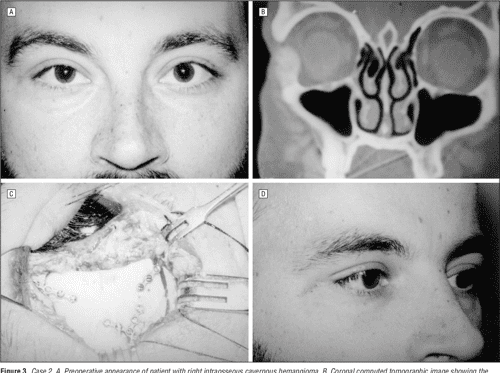 [PDF] Temporoparietal fascial flap in orbital reconstruction ...