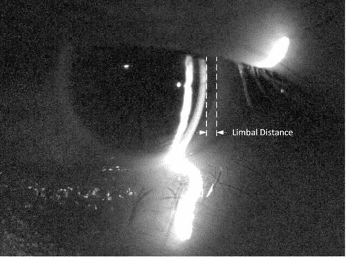 Table 1 from Parameterization of Limbus Distance in Van Herick method's ...