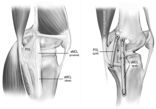 Figure 1 from A Biomechanical Comparison of the LaPrade Technique ...