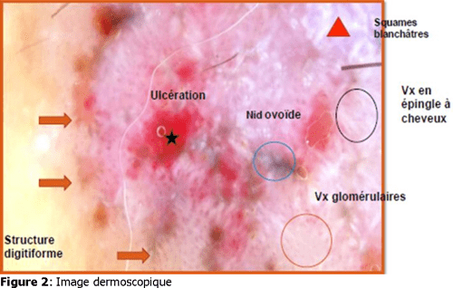 Figure 4 from L’apport de la dermoscopie dans le carcinome basosquameux ...