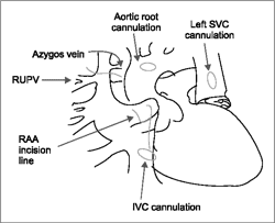 Figure 1 from Surgery for Partial Anomalous Pulmonary Venous ...