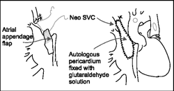 Figure 3 from Surgery for Partial Anomalous Pulmonary Venous ...