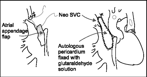 Figure 1 from Surgery for Partial Anomalous Pulmonary Venous ...
