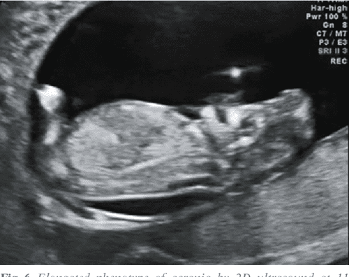 Figure 13 from Acrania-exencephaly-anencephaly sequence phenotypic ...