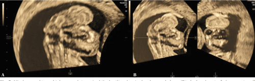 Figure 13 from Acrania-exencephaly-anencephaly sequence phenotypic ...
