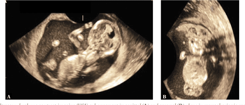 Figure 13 from Acrania-exencephaly-anencephaly sequence phenotypic ...