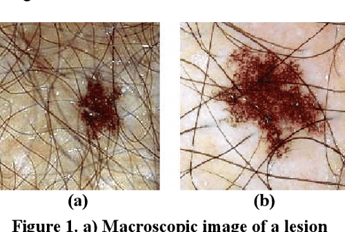 Figure 1 from Unsupervised border detection of skin lesion images ...