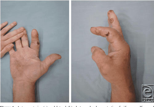 Figure I from Pyogenic (Suppurative) Flexor Tenosynovitis: Assessment ...