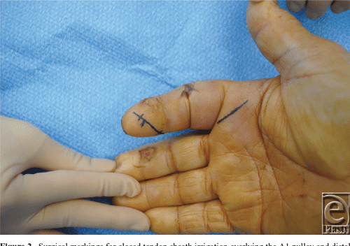 Figure I from Pyogenic (Suppurative) Flexor Tenosynovitis: Assessment ...