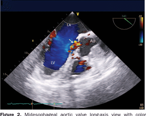 Figure 1 from Retrograde type A aortic dissection after ...