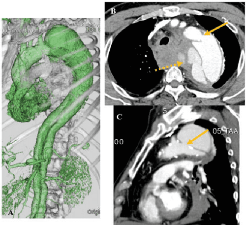 Figure 1 from Candy-plug technique for ruptured chronic type B aortic ...