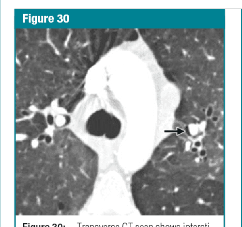 [PDF] Fleischner Society: glossary of terms for thoracic imaging ...