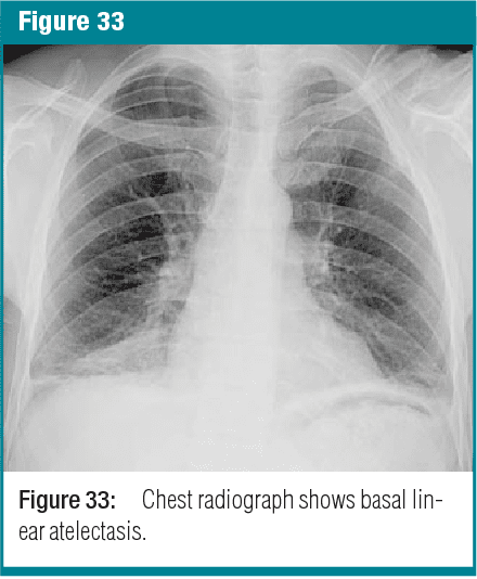 [PDF] Fleischner Society: glossary of terms for thoracic imaging ...