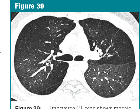 [PDF] Fleischner Society: glossary of terms for thoracic imaging ...